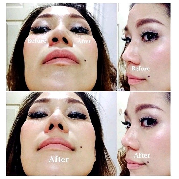 ( 10-302-01 ) Korean Nose Up 3D Rhinorlasty High Stealth Increased The ...