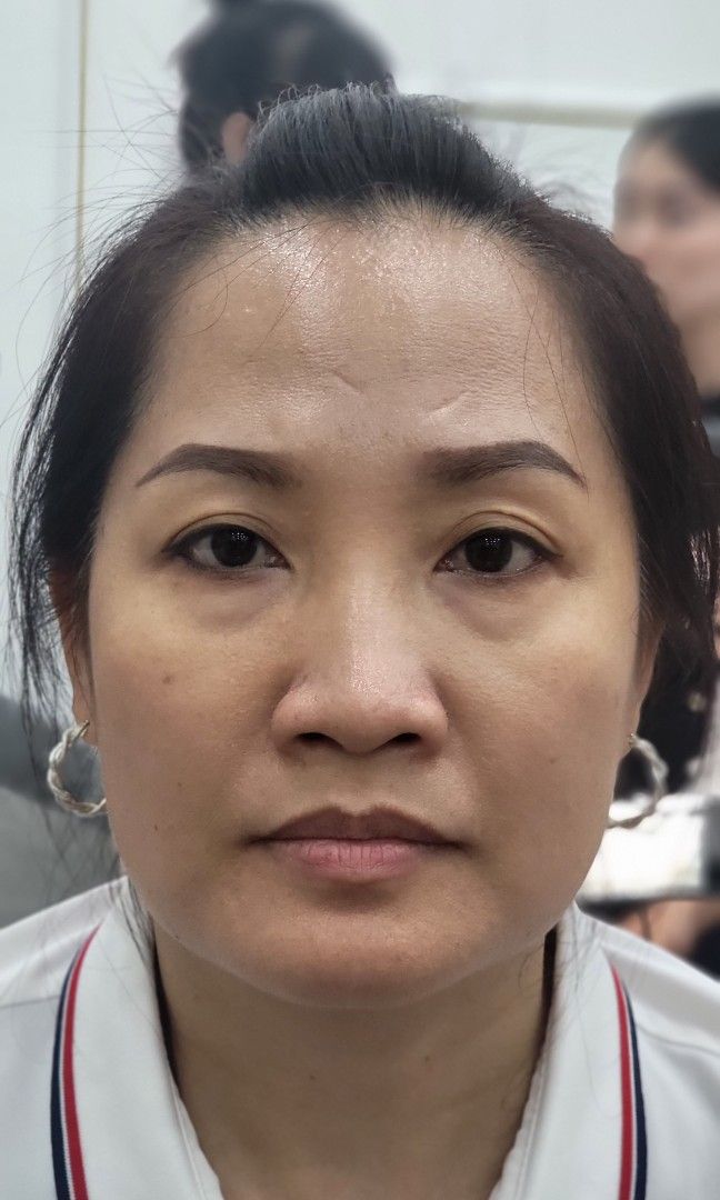 TREATMENT Plasma Anna Beauty lounge 190 fortune center #01-22 Singapore ...