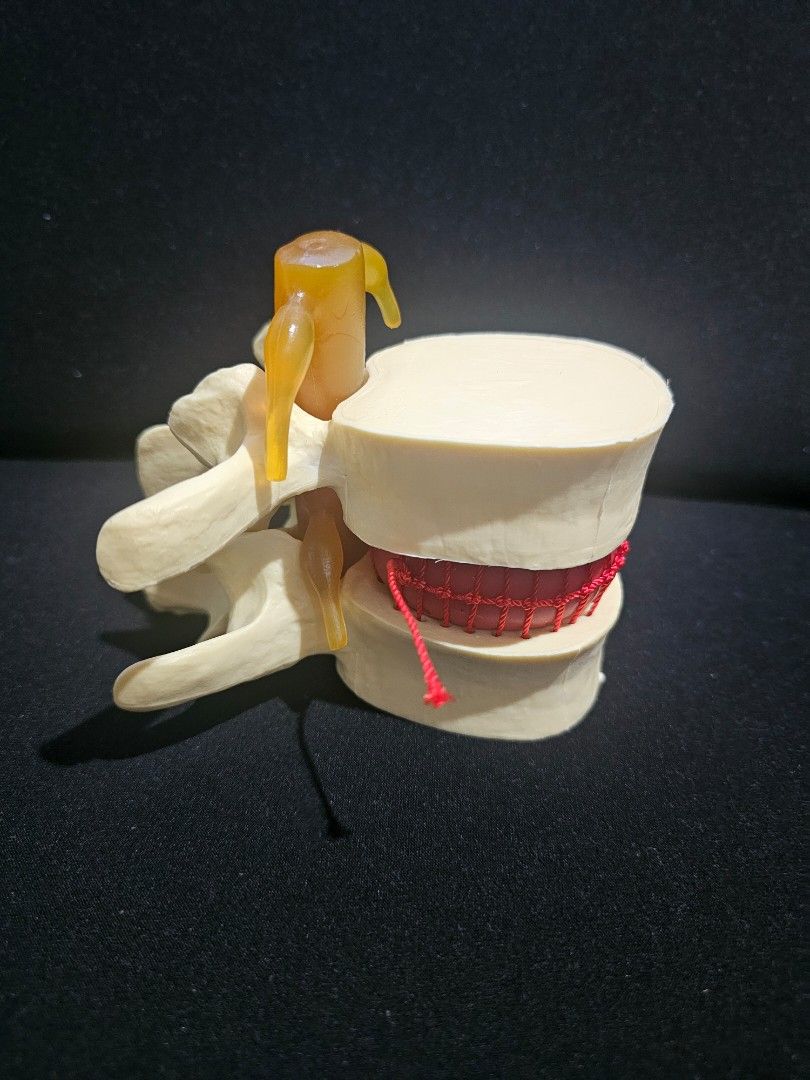 Lumbar Vertebrae Model Anatomical Spine Lumbar Disc Herniation Anatomy ...