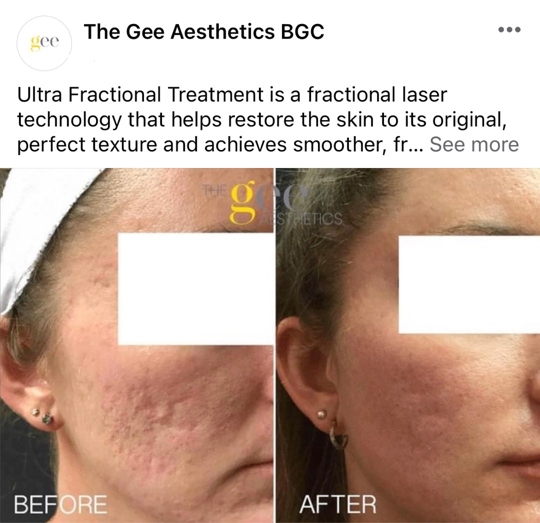 Voucher CO2 Fractional Laser for Acne Scars (Gee Aesthetics), Tickets ...