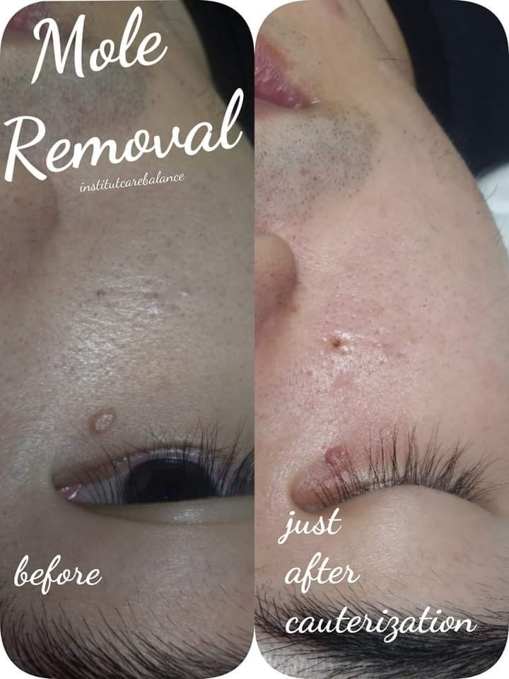 Milia Seed﻿,Skin Tag,Wart﻿,Syringoma,Tiny Bump,Oil Clog,Xanthelasma,Cholesterol, Mole﻿,Sebaceous ...