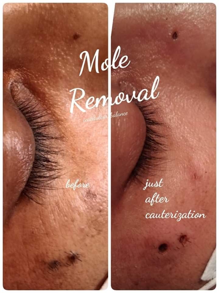 Milia Seed﻿,Skin Tag,Wart﻿,Syringoma,Tiny Bump,Oil Clog,Xanthelasma,Cholesterol, Mole﻿,Sebaceous ...