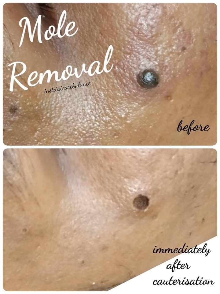 Milia Seed﻿,Skin Tag,Wart﻿,Syringoma,Tiny Bump,Oil Clog,Xanthelasma,Cholesterol, Mole﻿,Sebaceous ...