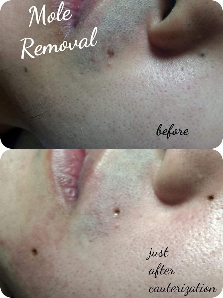 Milia Seed﻿,Skin Tag,Wart﻿,Syringoma,Tiny Bump,Oil Clog,Xanthelasma,Cholesterol, Mole﻿,Sebaceous ...