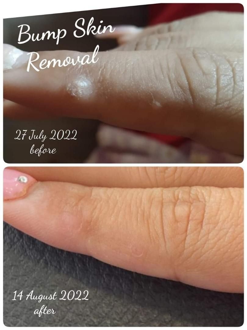 Milia Seed﻿,Skin Tag,Wart﻿,Syringoma,Tiny Bump,Oil Clog,Xanthelasma,Cholesterol, Mole﻿,Sebaceous ...