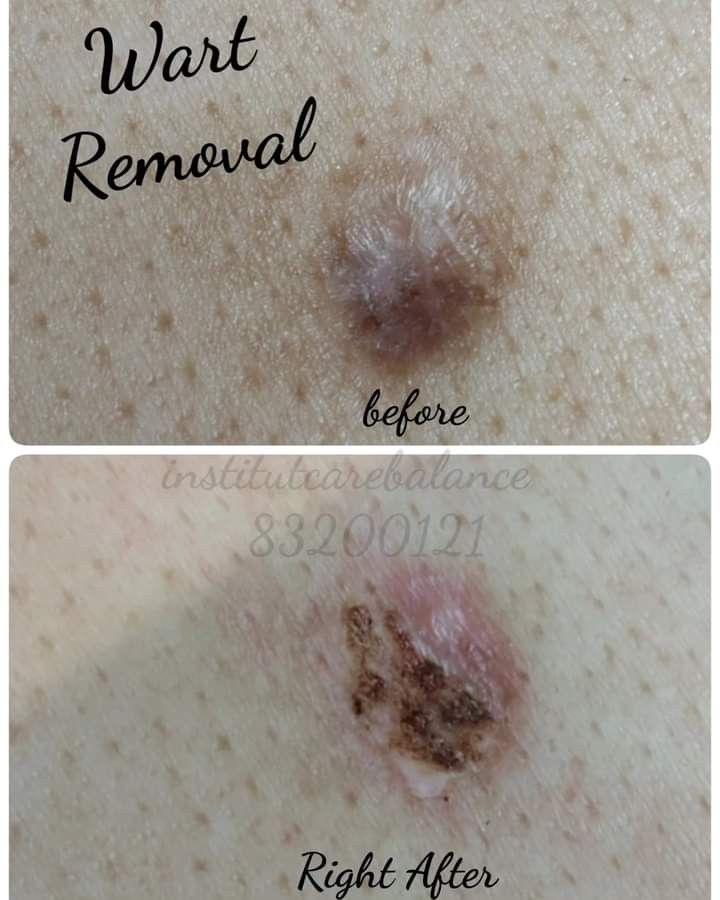 Mole Removal Milia Seed﻿,Skin Tag,Wart﻿,Syringoma,Tiny Bump,Oil Clog,Xanthelasma,Cholesterol ...