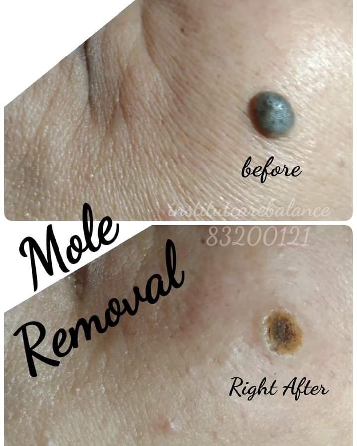 Scarless Mole Removal Milia Seed﻿,Skin Tag,Wart﻿,Syringoma,Tiny Bump ...