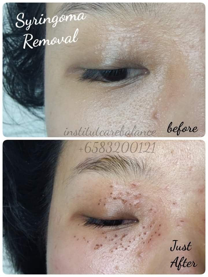 Scarless Mole Removal Milia Seed﻿,Skin Tag,Wart﻿,Syringoma,Tiny Bump,Oil Clog,Xanthelasma ...