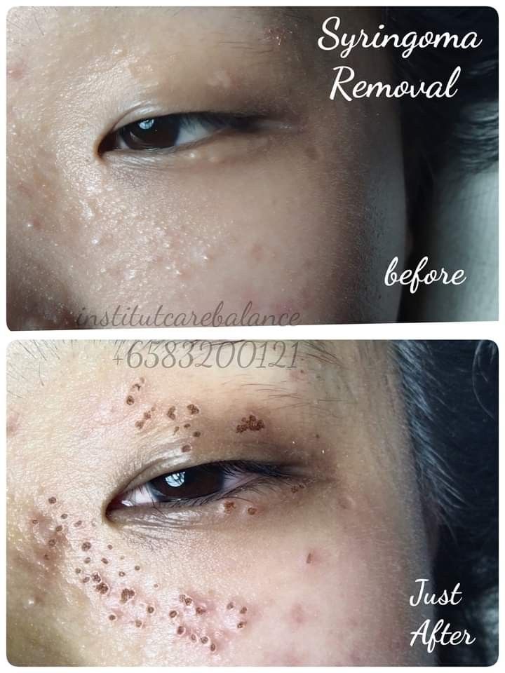 Scarless Mole Removal Milia Seed﻿,Skin Tag,Wart﻿,Syringoma,Tiny Bump,Oil Clog,Xanthelasma ...