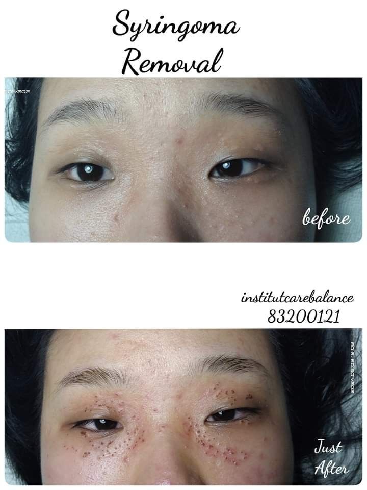 Scarless Mole Removal Milia Seed﻿,Skin Tag,Wart﻿,Syringoma,Tiny Bump,Oil Clog,Xanthelasma ...