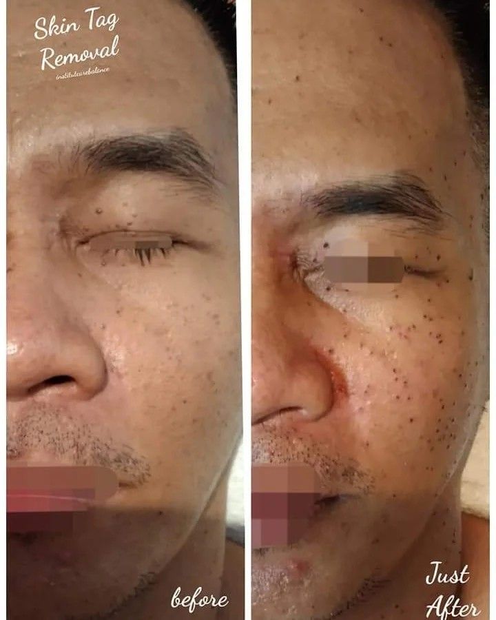 Scarless Mole Removal Milia Seed﻿,Skin Tag,Wart﻿,Syringoma,Tiny Bump ...