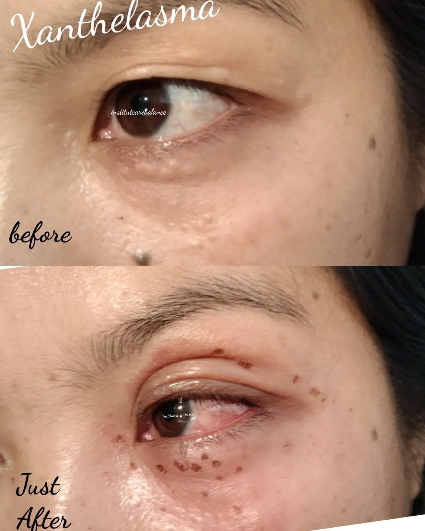 Scarless Mole Removal Milia Seed﻿,Skin Tag,Wart﻿,Syringoma,Tiny Bump,Oil Clog,Xanthelasma ...