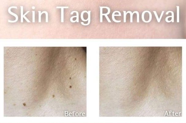 Milia Seed﻿,Skin Tag,Wart﻿,Syringoma,Tiny Bump,Oil Clog,Xanthelasma,Cholesterol, Mole﻿,Sebaceous ...