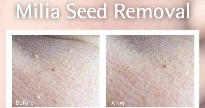 Scarless Mole Removal Milia Seed﻿,Skin Tag,Wart﻿,Syringoma,Tiny Bump,Oil Clog,Xanthelasma ...