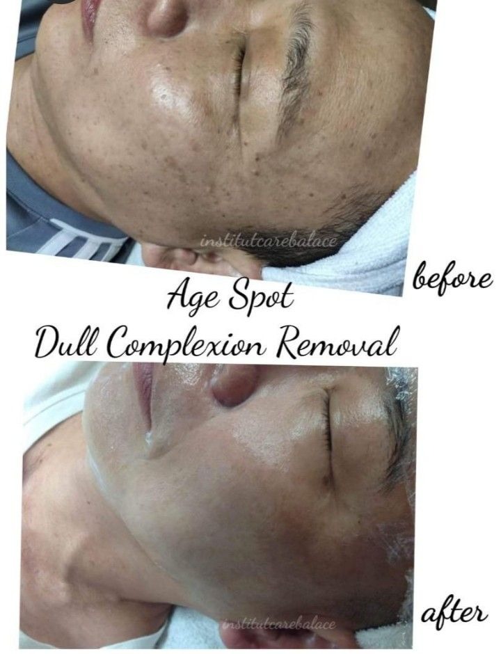 Pigmentation ,Age Spot, Freckles, Melasma,Lentigo,Sun Spot,Dark Spot ...