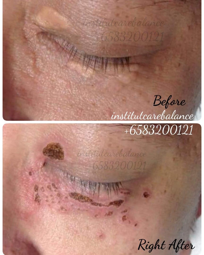 Milia Seed﻿,Skin Tag,Wart﻿,Syringoma,Tiny Bump,Oil Clog,Xanthelasma,Cholesterol, Mole﻿,Sebaceous ...