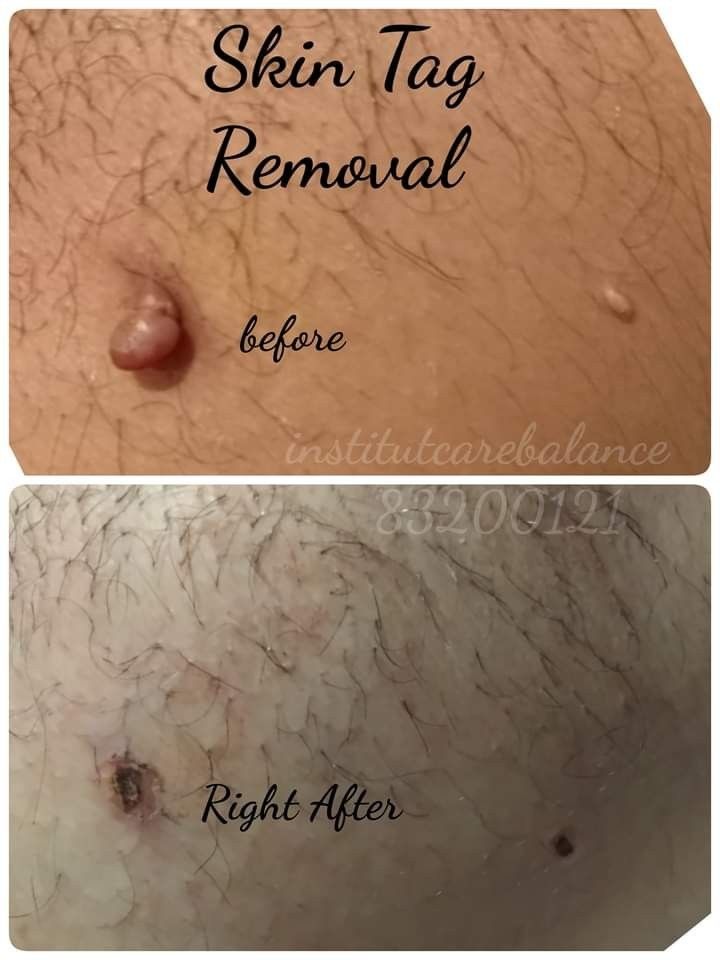 Milia Seed﻿,Skin Tag,Wart﻿,Syringoma,Tiny Bump,Oil Clog,Xanthelasma,Cholesterol, Mole﻿,Sebaceous ...