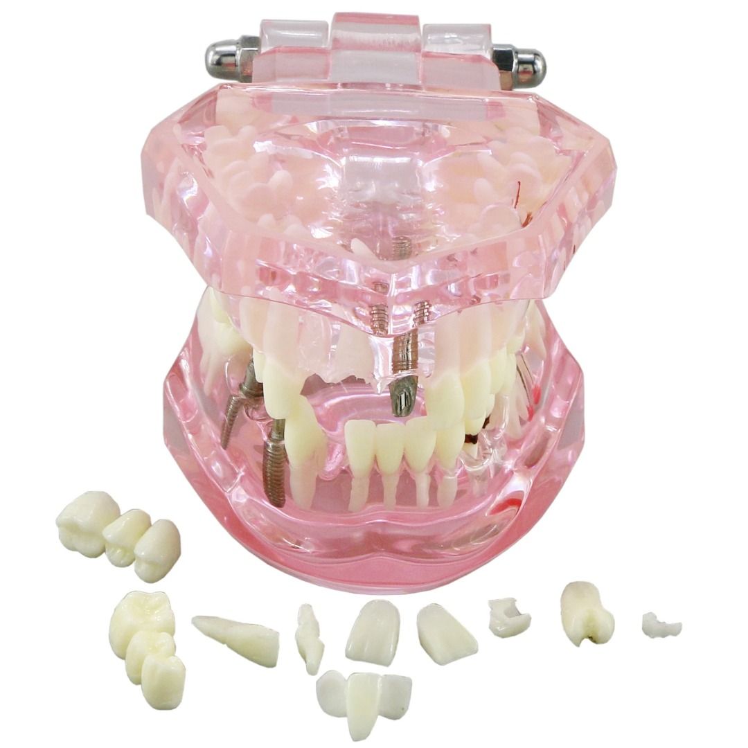 Dental Standard Teeth Model Practice Implant Restoration Disease ...