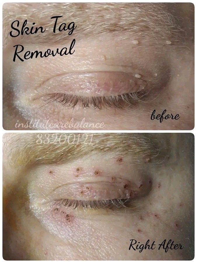 Milia Seed﻿,Skin Tag,Wart﻿,Syringoma,Tiny Bump,Oil Clog,Xanthelasma,Cholesterol, Mole﻿,Sebaceous ...