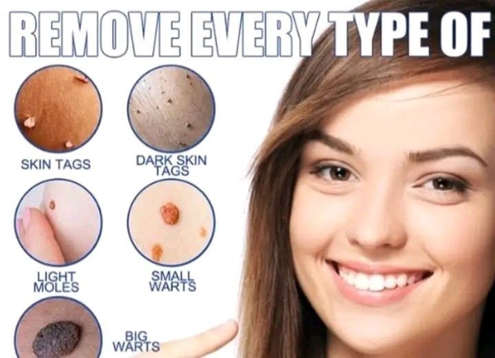 Milia Seed﻿,Skin Tag,Wart﻿,Syringoma,Tiny Bump,Oil Clog,Xanthelasma,Cholesterol, Mole﻿,Sebaceous ...