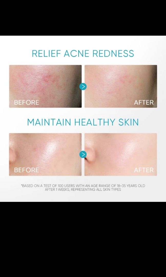 SKINTIFIC 5% Panthenol Acne Calming Water Facial Moisturizer Gel Day ...