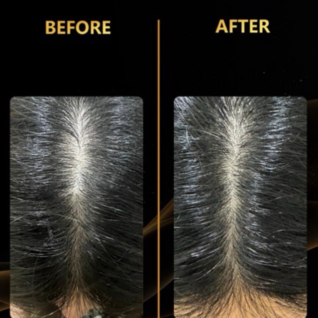 SOM1 SDEEN Japanese Patent Hair Growth Hair Shampoo & Treatment [SOM1 ...