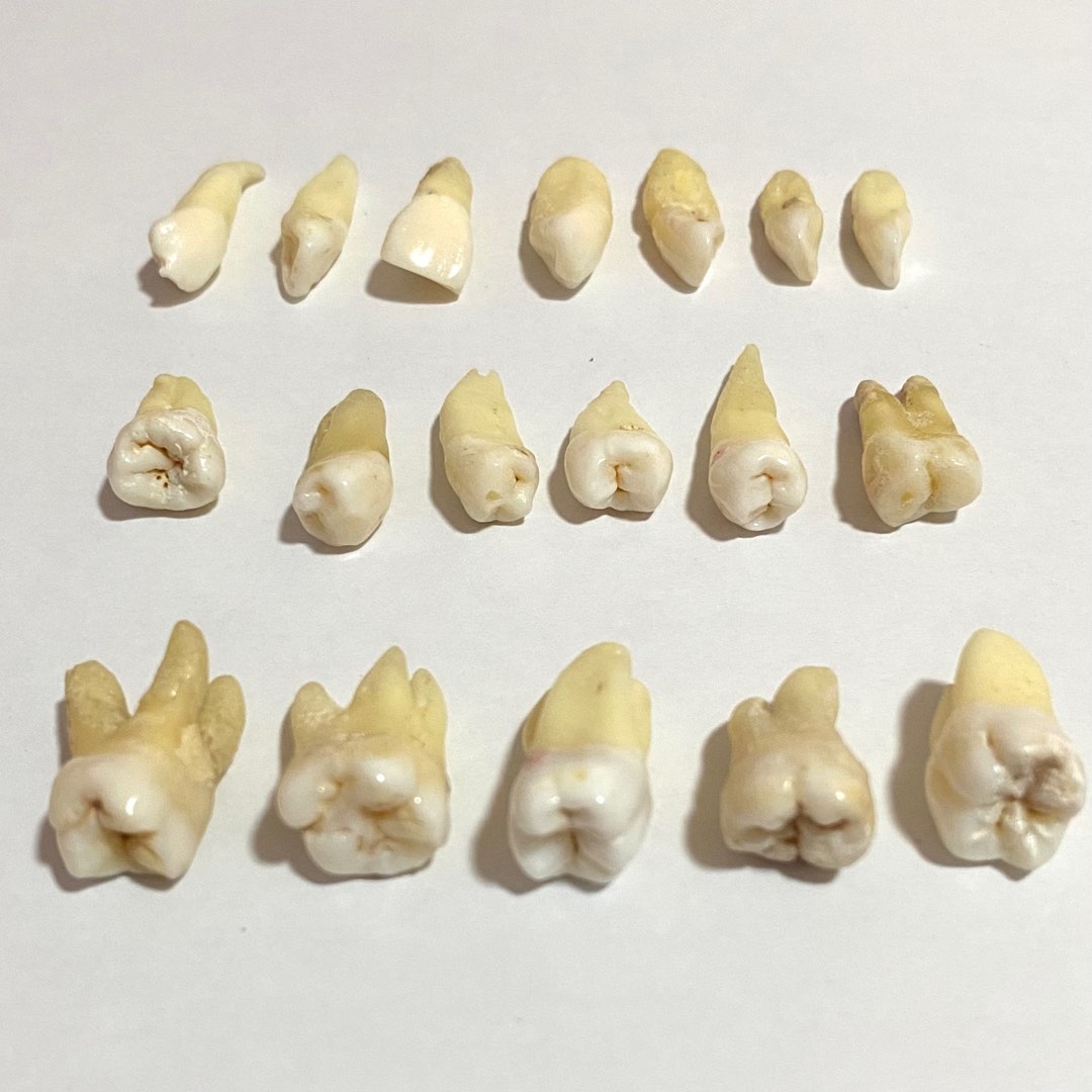 Natural Tooth Specimen Oral Ana Endo Resto Endo Perio, Health ...