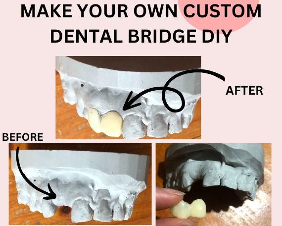 Dental Bridge DIY Custom Resin Bridge Make your Own, Easy and Realistic ...