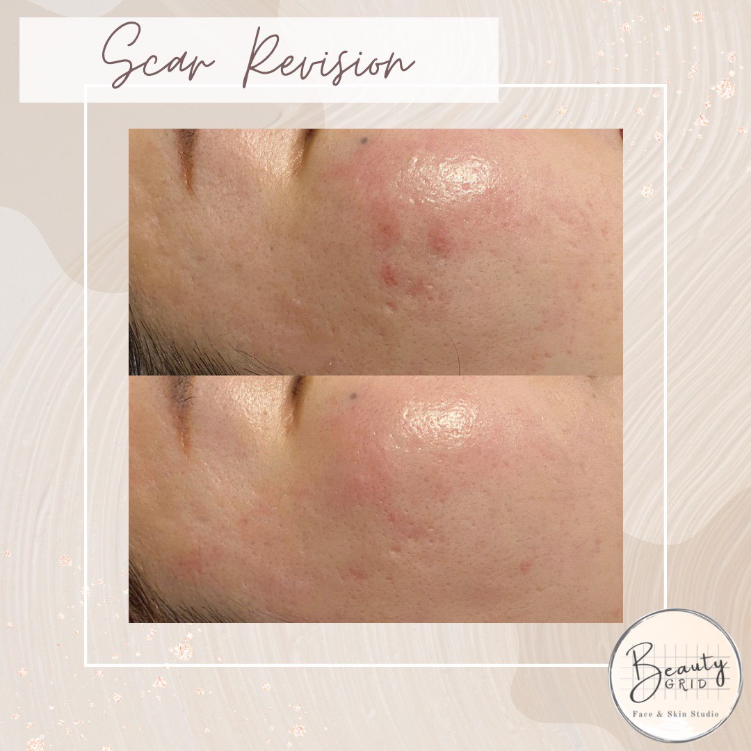 Pitted scar revision, Beauty & Personal Care, Face, Face Care Products ...