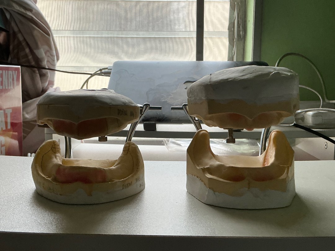 CD Complete Denture Edentulous Mounted Casts (Patient and Ideal) on ...