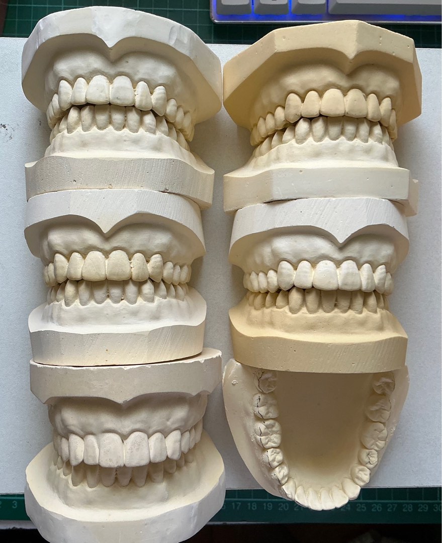 Dentulous Patient Casts RPD Casts for DLE Boards - Sir Marvin Casts ...