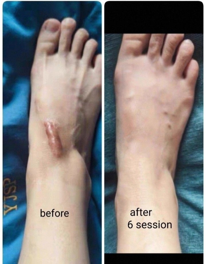 Keloid Sebaceous Hyperplasia Milla seed Mole Bump oil clog Skin tag ...