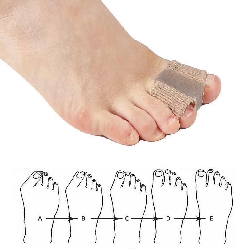 Toe Separator - Bunion Corrector - New, Health & Nutrition, Braces ...